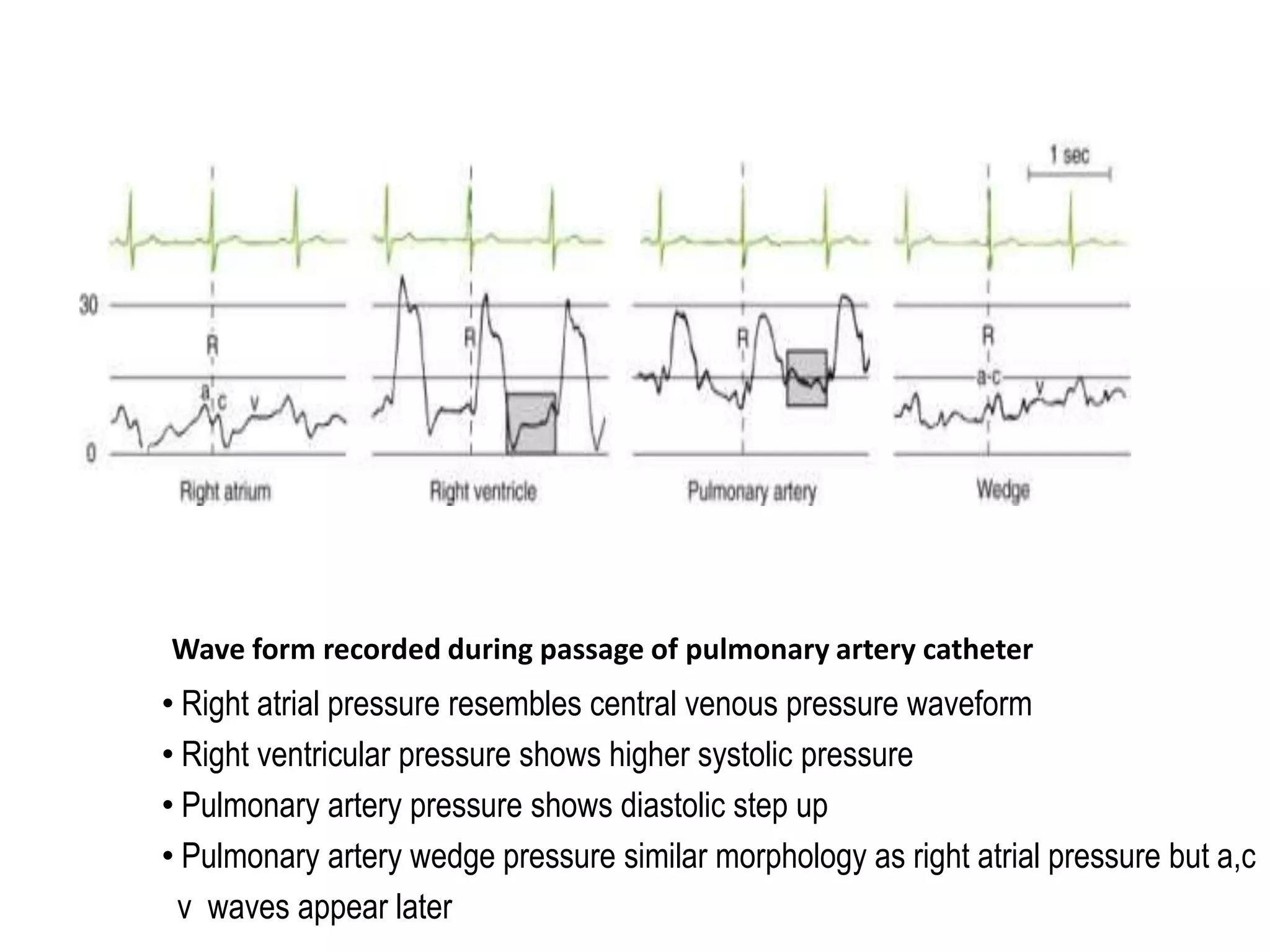 Pulmonary artery-catheter2 | PPTX