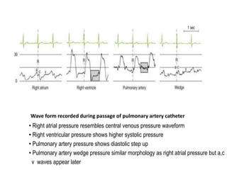 Pulmonary artery-catheter2 | PPTX