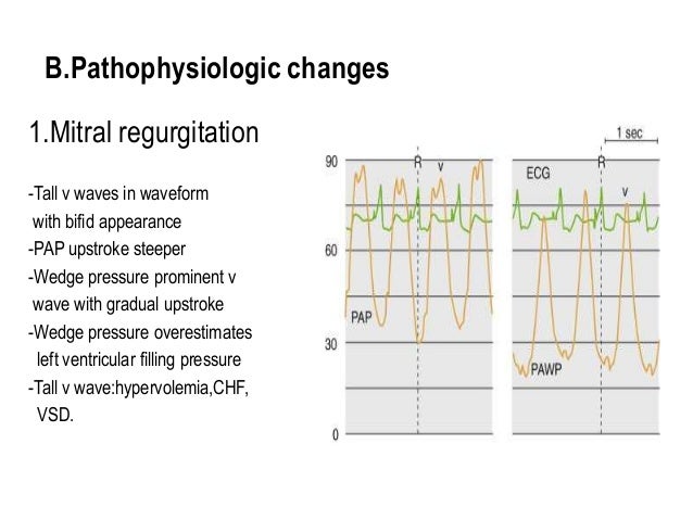Pulmonary artery-catheter2