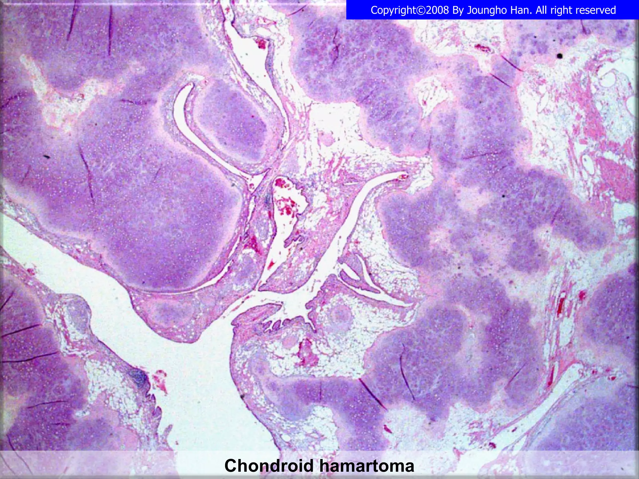 Pulmonary chondroid hamartoma | PPS