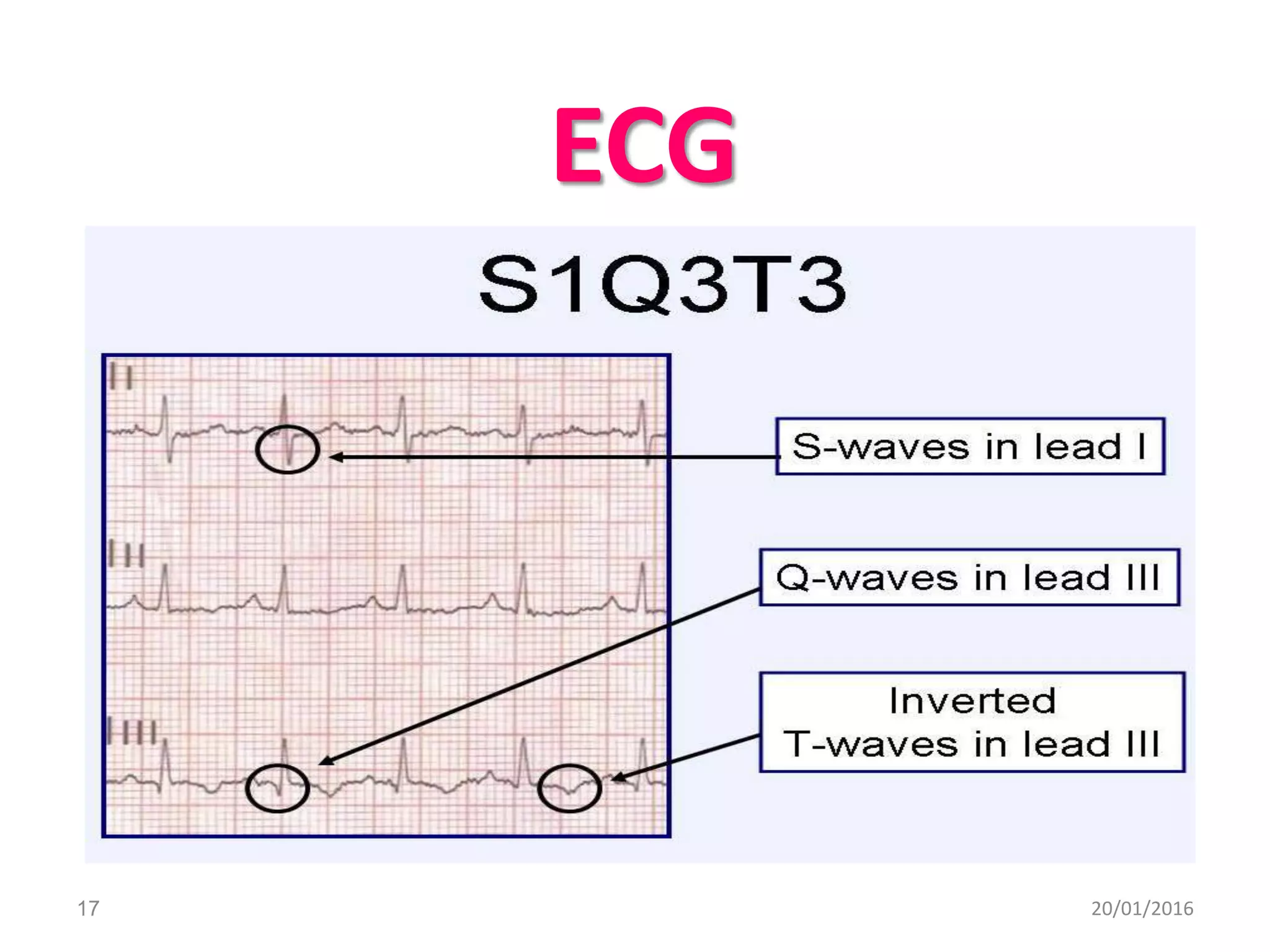 Pulmonary Embolism | PPTX