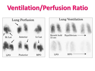 Pulmonary Embolism | PPTX