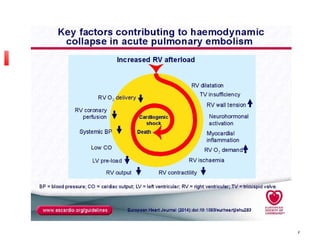 Pulmonary Embolism Perc