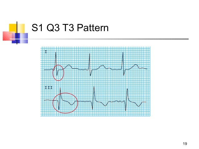 Pulmonary embolism ( PE)