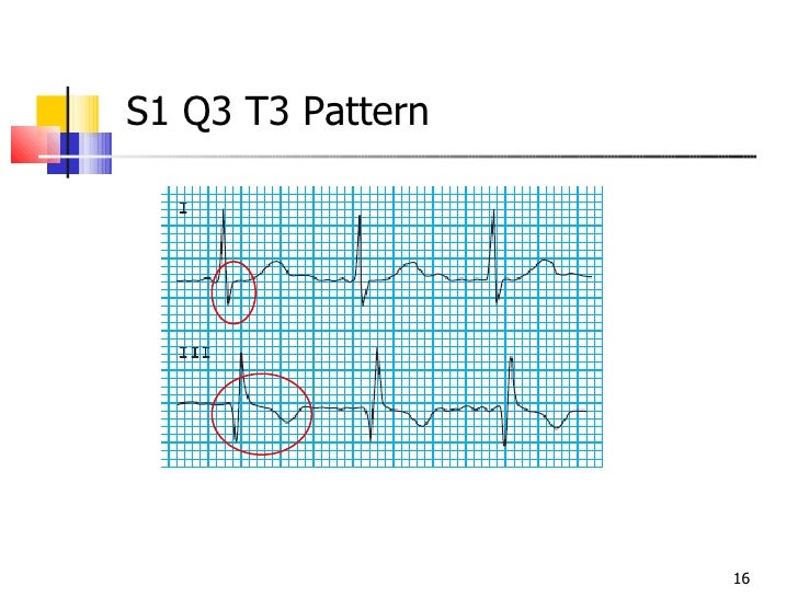 Pulmonary Embolism