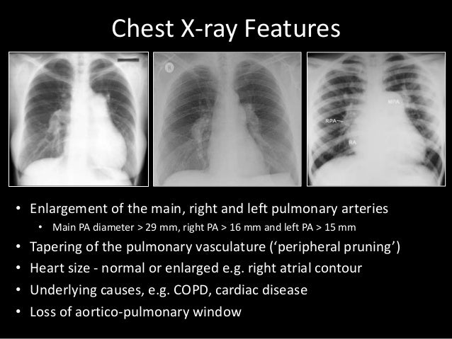 Pulmonary hypertension in the ICU