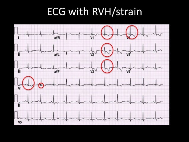 Pulmonary hypertension in the ICU