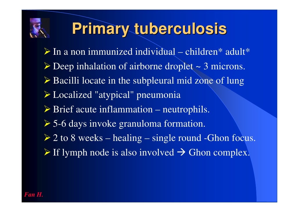Pulmonary Tuberculosis