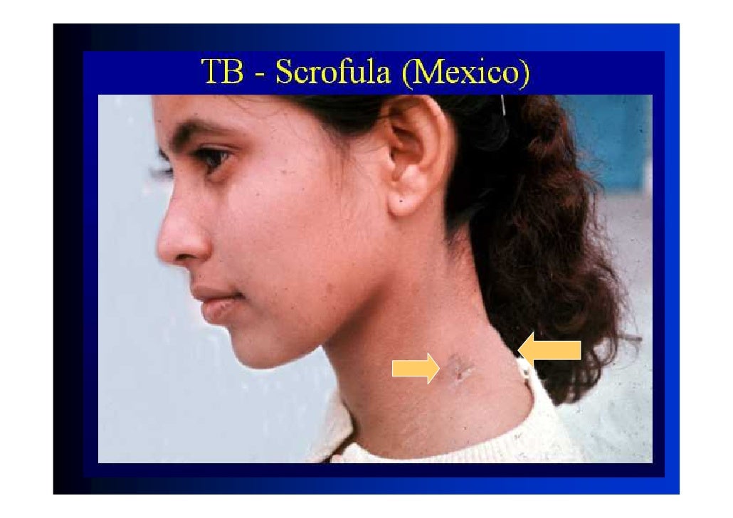 Miliary Tuberculosis Skin
