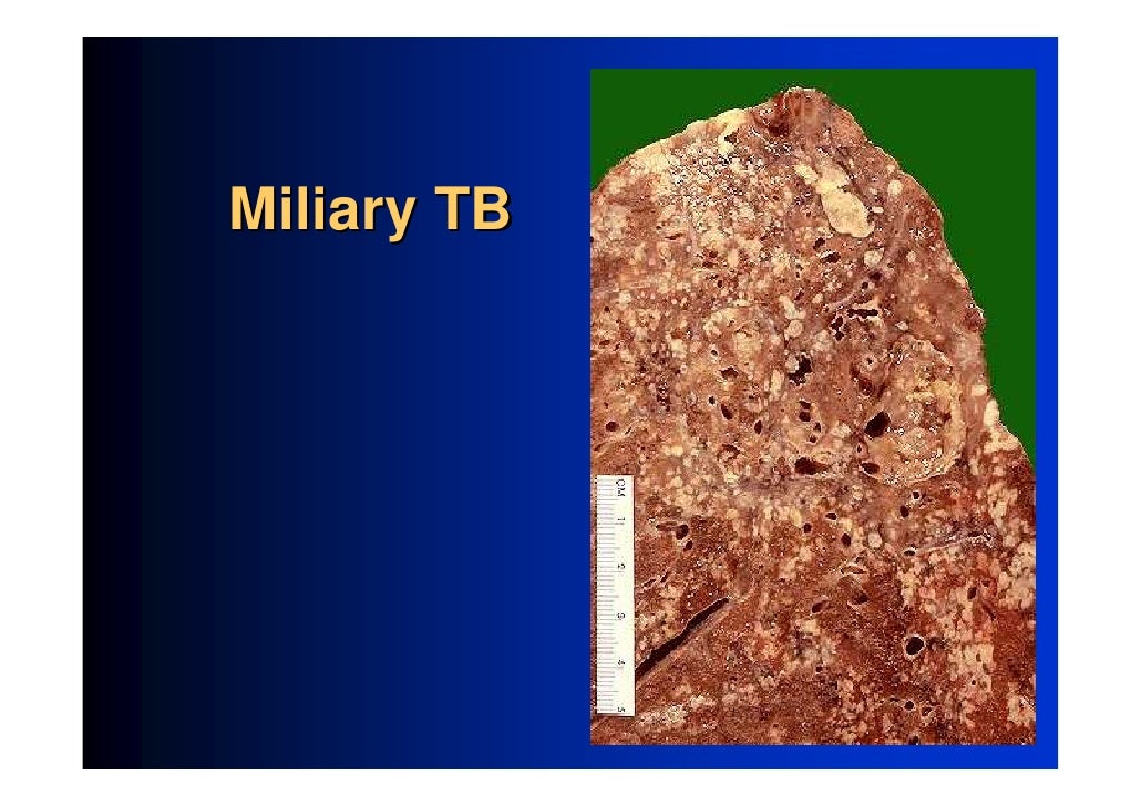 Pulmonary Tuberculosis