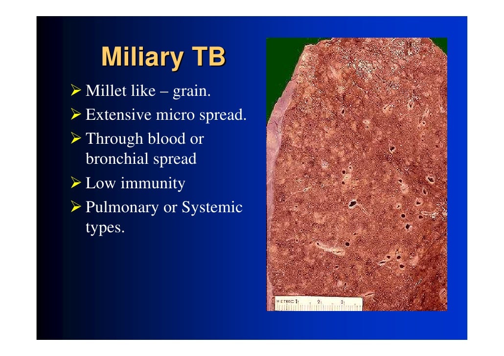 Pulmonary Tuberculosis