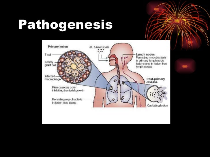 Pulmonary Tuberculosis Presentation
