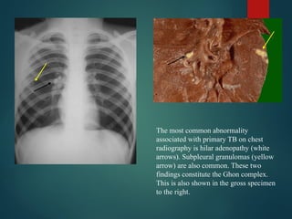 Pulmonary lung pathology -Tuberculosis.pptx