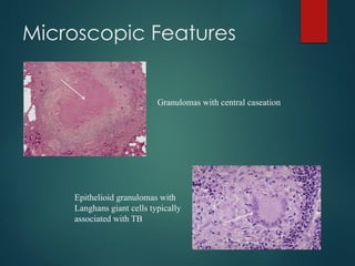 Pulmonary lung pathology -Tuberculosis.pptx