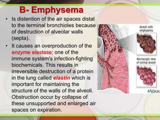 Pulmonary Diseases | PPT
