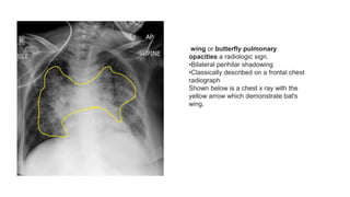 pulmonary edema pptsssssssssssssssssssss | PPTX