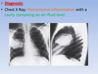 Pulmonary Abscess in Children .. Dr Padmesh | PPTX