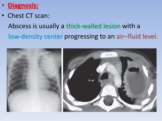 Lung Abscess Neonate