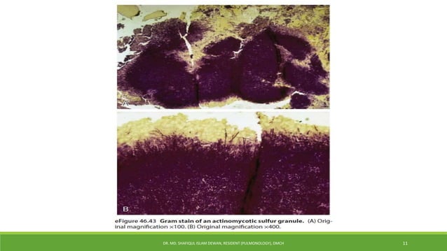 Pulmonary Actinomycosis.pptx | Lung and Respiratory Health | Diseases ...