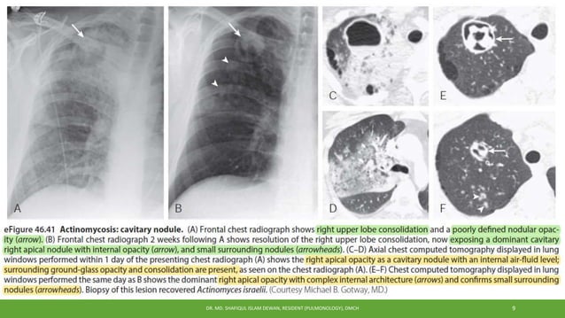 Pulmonary Actinomycosis.pptx | Lung and Respiratory Health | Diseases ...