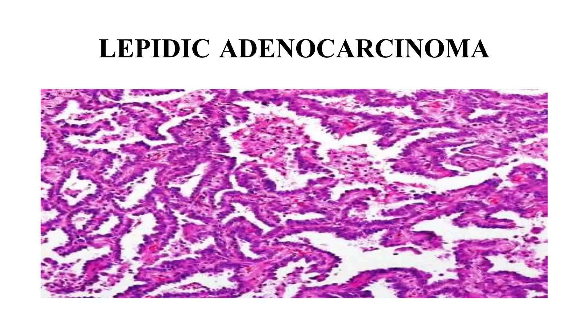 Histopathological subtypes and molecular alterations in pulmonary ...