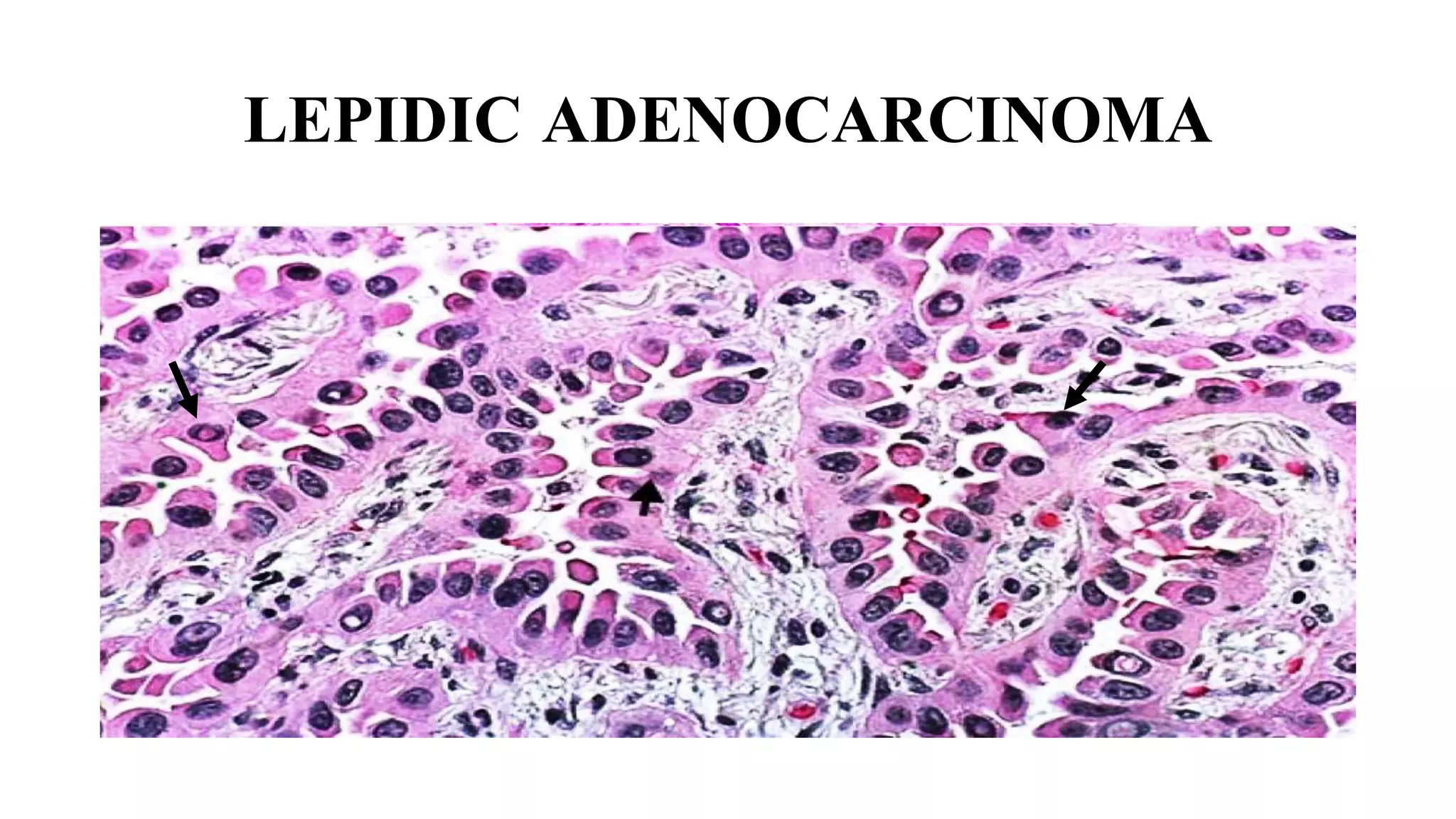 Histopathological subtypes and molecular alterations in pulmonary ...