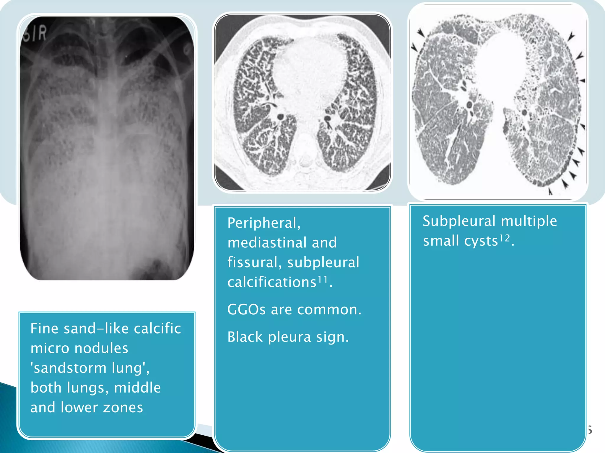 Pulmonary alveolar microlithiasis | PPTX