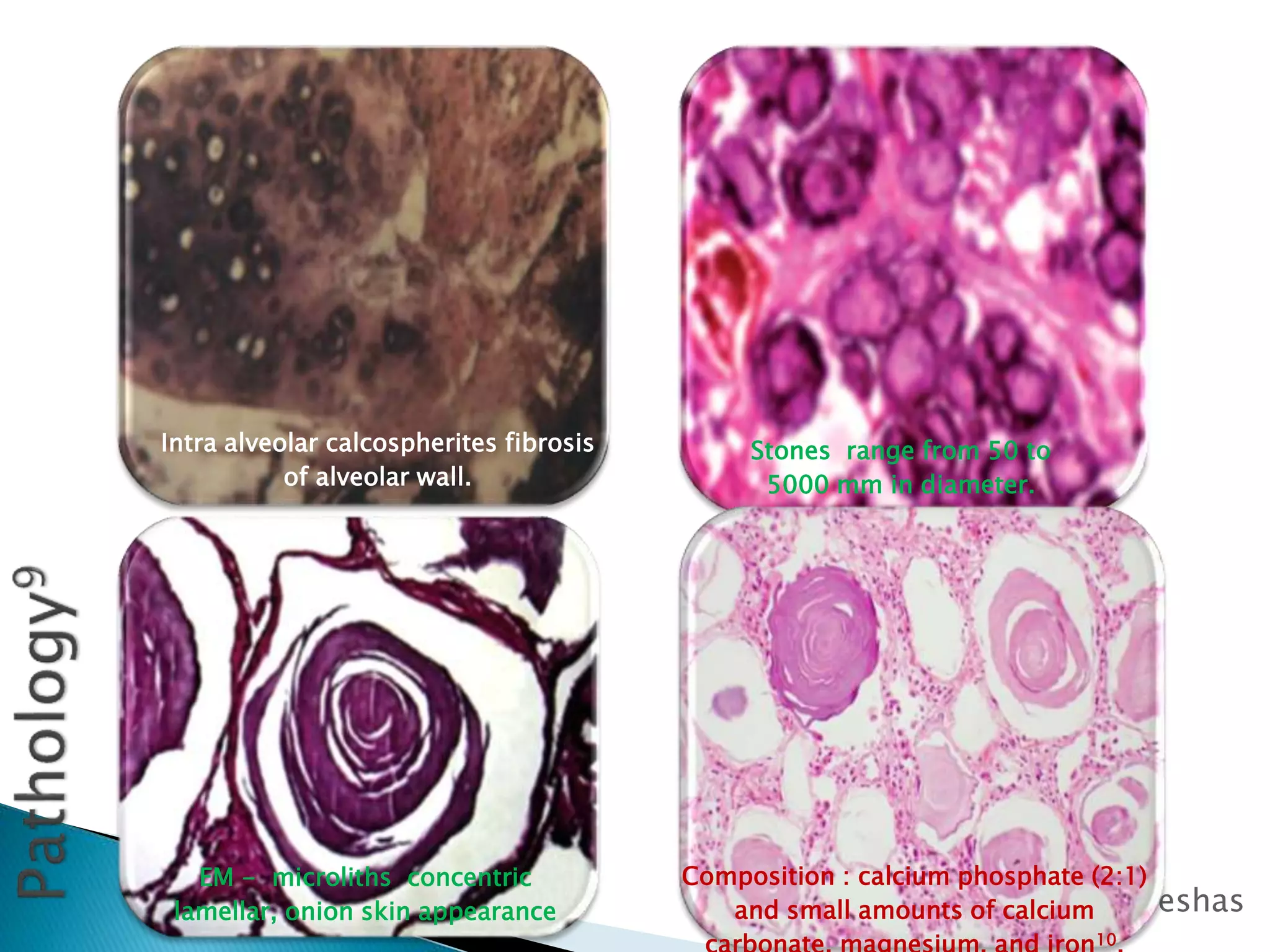 Pulmonary alveolar microlithiasis | PPTX