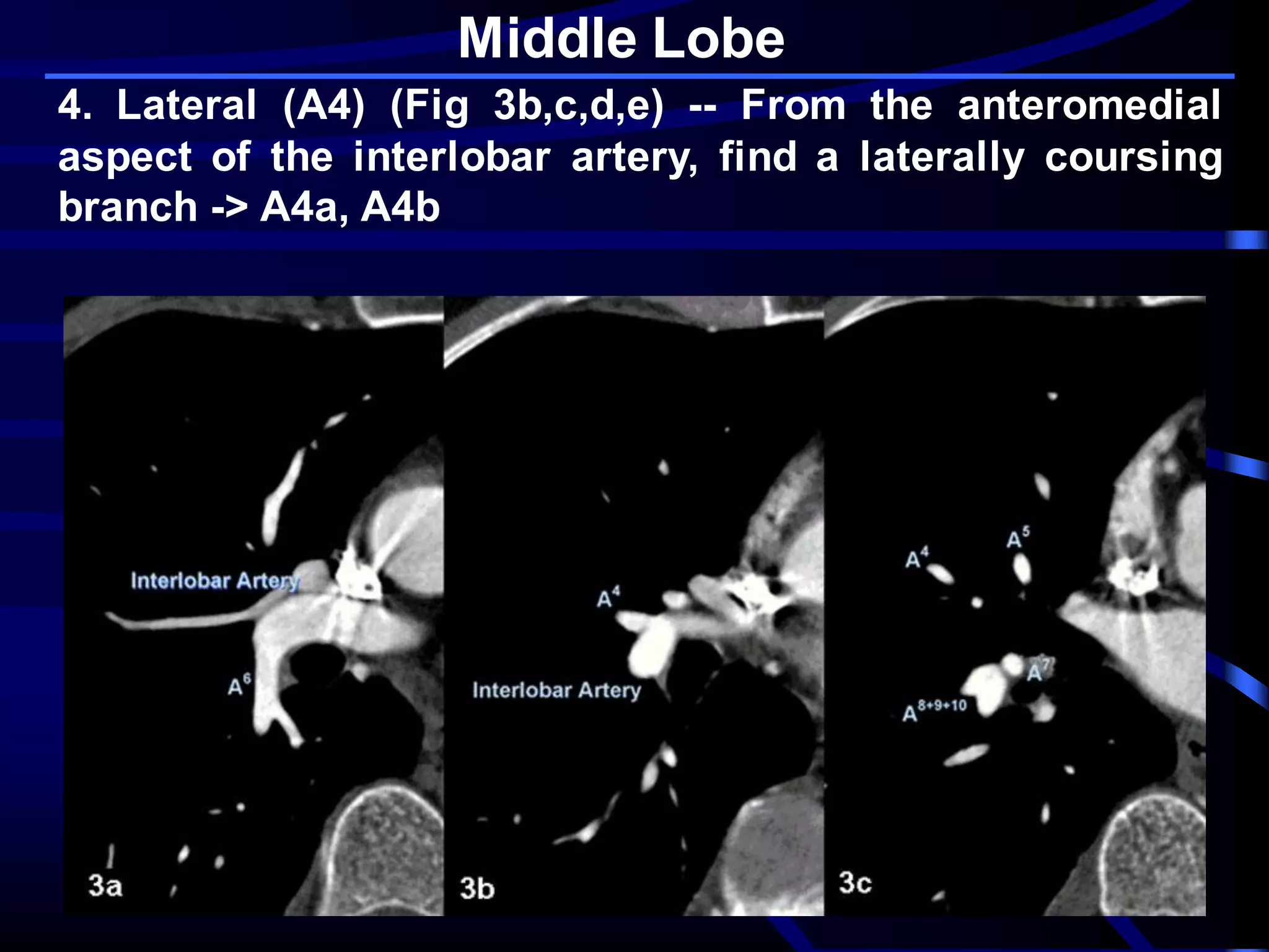 Pulmonary Artery Anatomy and Pulmonary Embolism | PDF