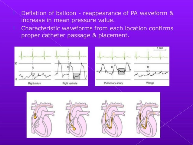 Pulmonary artery catherisation