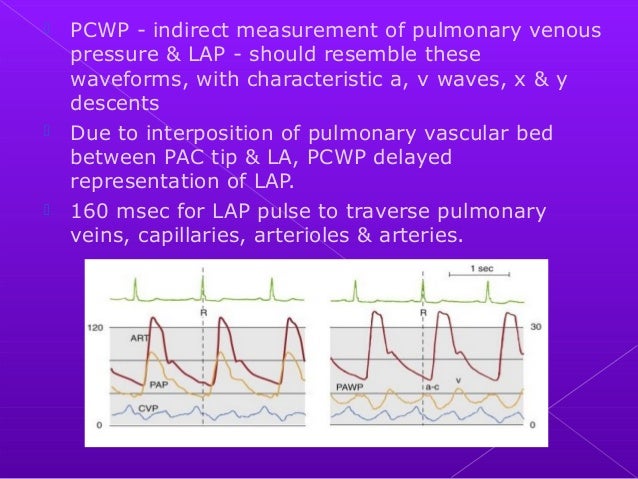 Pulmonary artery catherisation