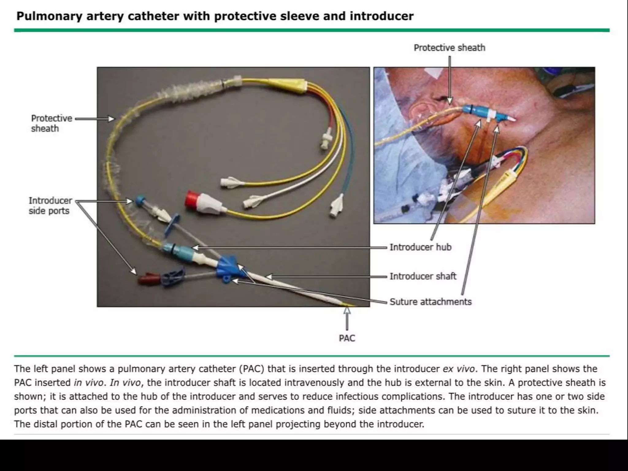 Pulmonary artery catheter | PPTX