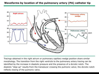 Pulmonary Artery Catheter Waveforms