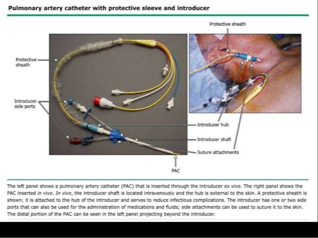 Pulmonary artery catheter