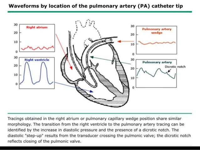 Pulmonary artery catheter
