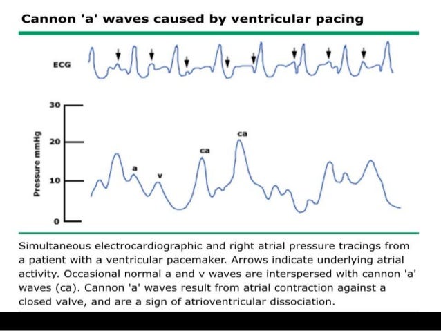 Pulmonary artery catheter