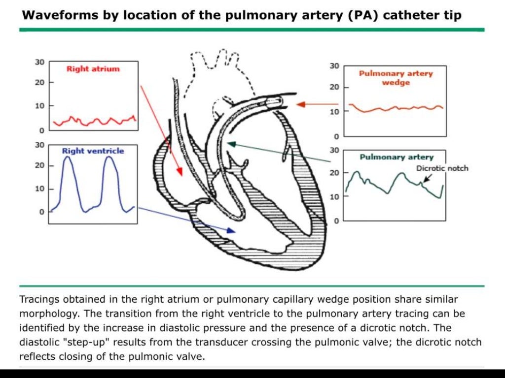 Pulmonary artery catheter