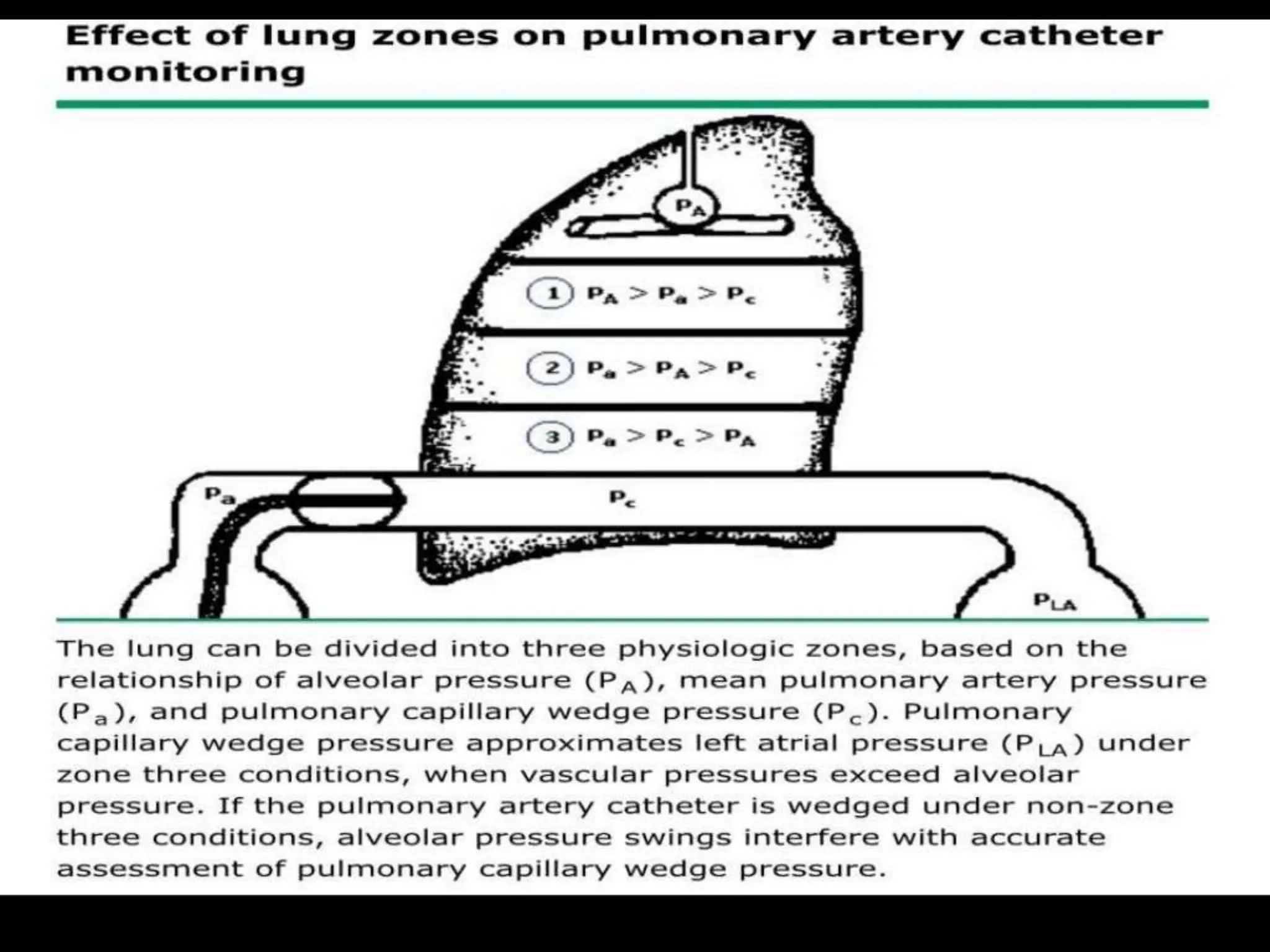 pulmonary artery catheter ppt.pptx