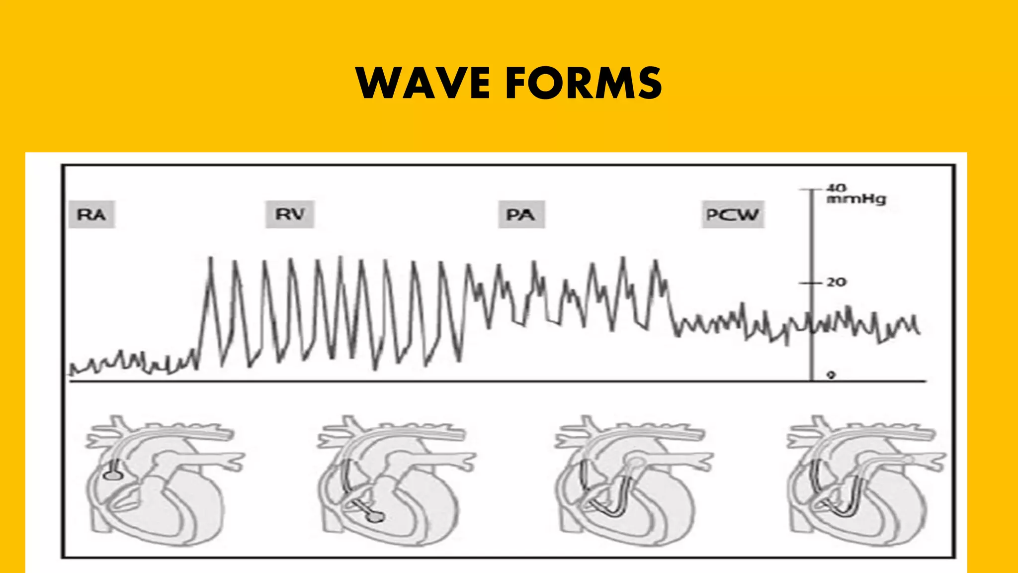 Pulmonary artery pressure monitoring | PPTX
