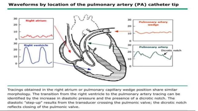 Pulmonary artery pressure monitoring | PPTX | First Aid | Injuries