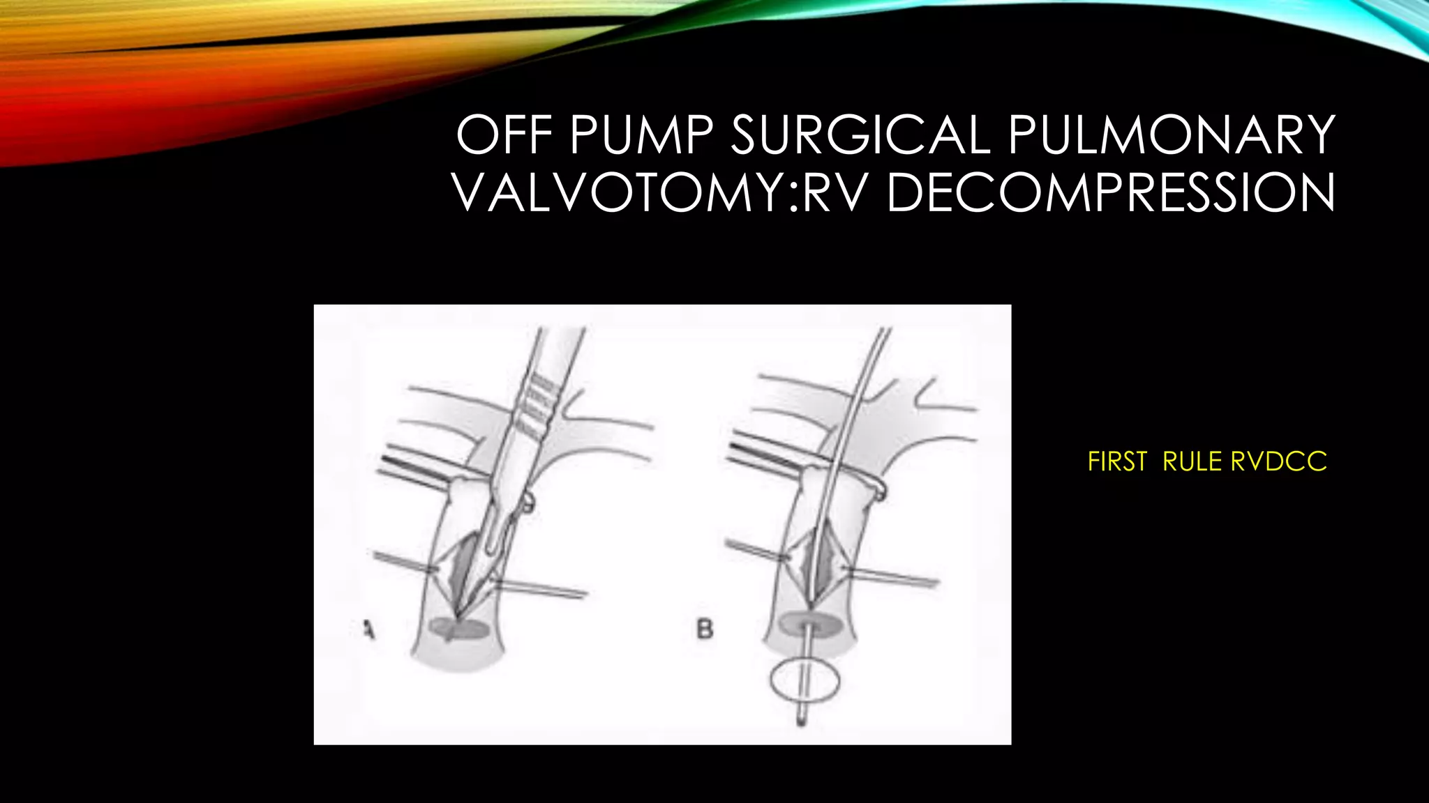Pulmonary atresia with intact ventricular septum | PPTX