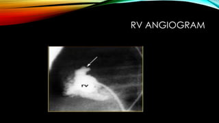 Pulmonary atresia with intact ventricular septum | PPTX | Heart and ...