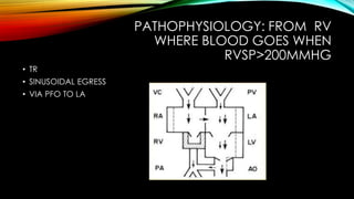 Pulmonary atresia with intact ventricular septum | PPTX