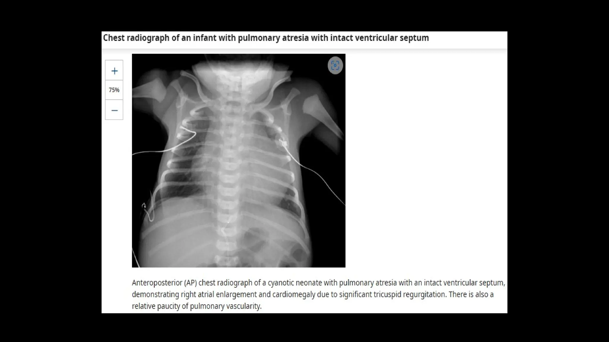 Pulmonary atresia without VSD (PAIVS).pptx