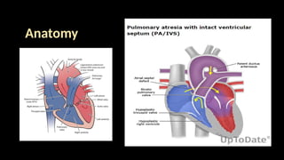 Pulmonary atresia without VSD (PAIVS).pptx