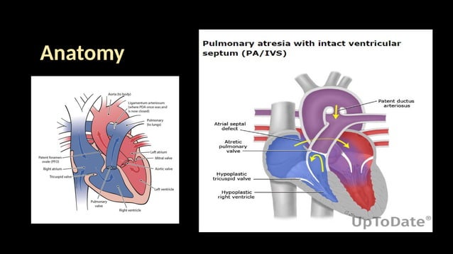 Pulmonary atresia without VSD (PAIVS).pptx