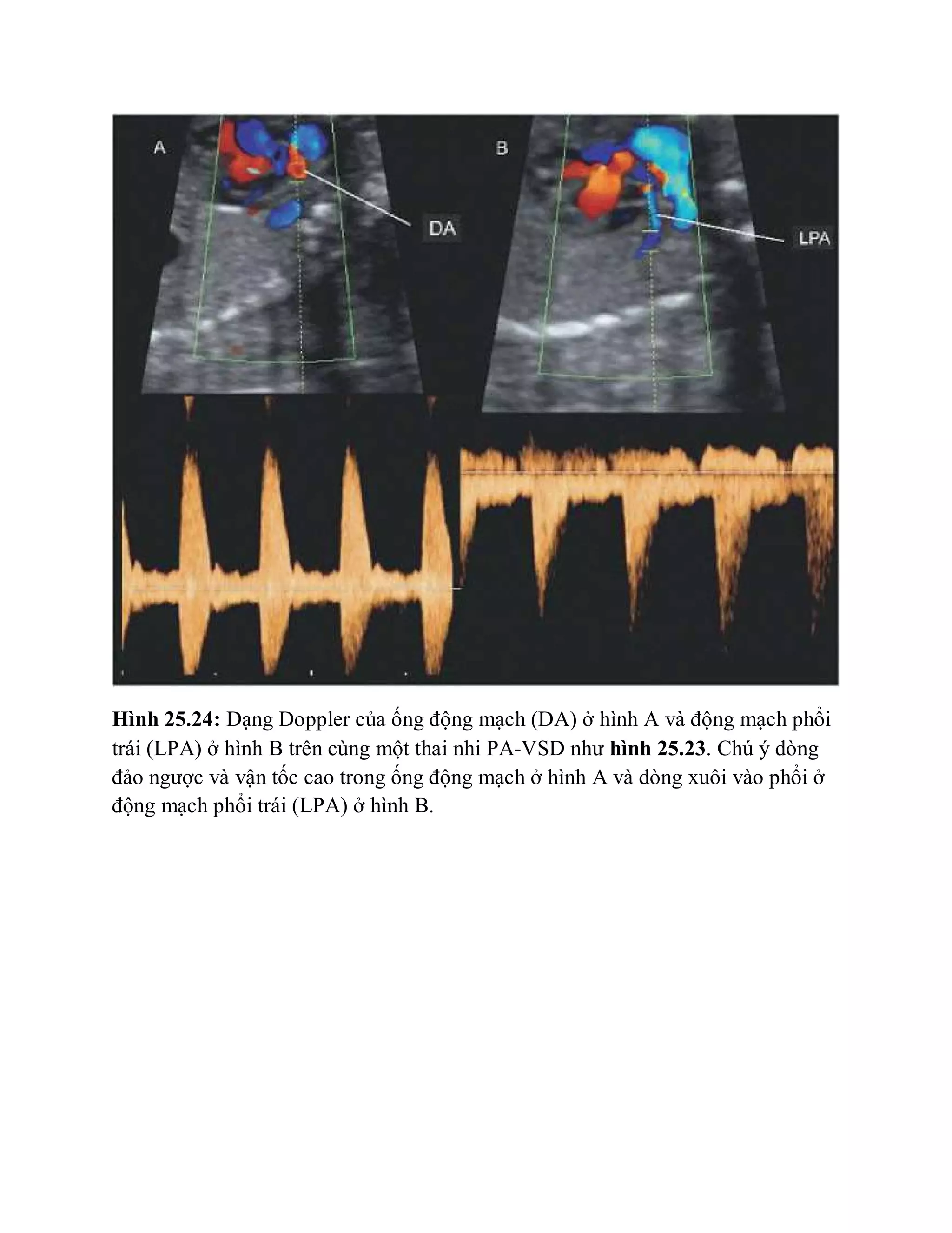 Pulmonary atresia with ventricular septal defect | PDF