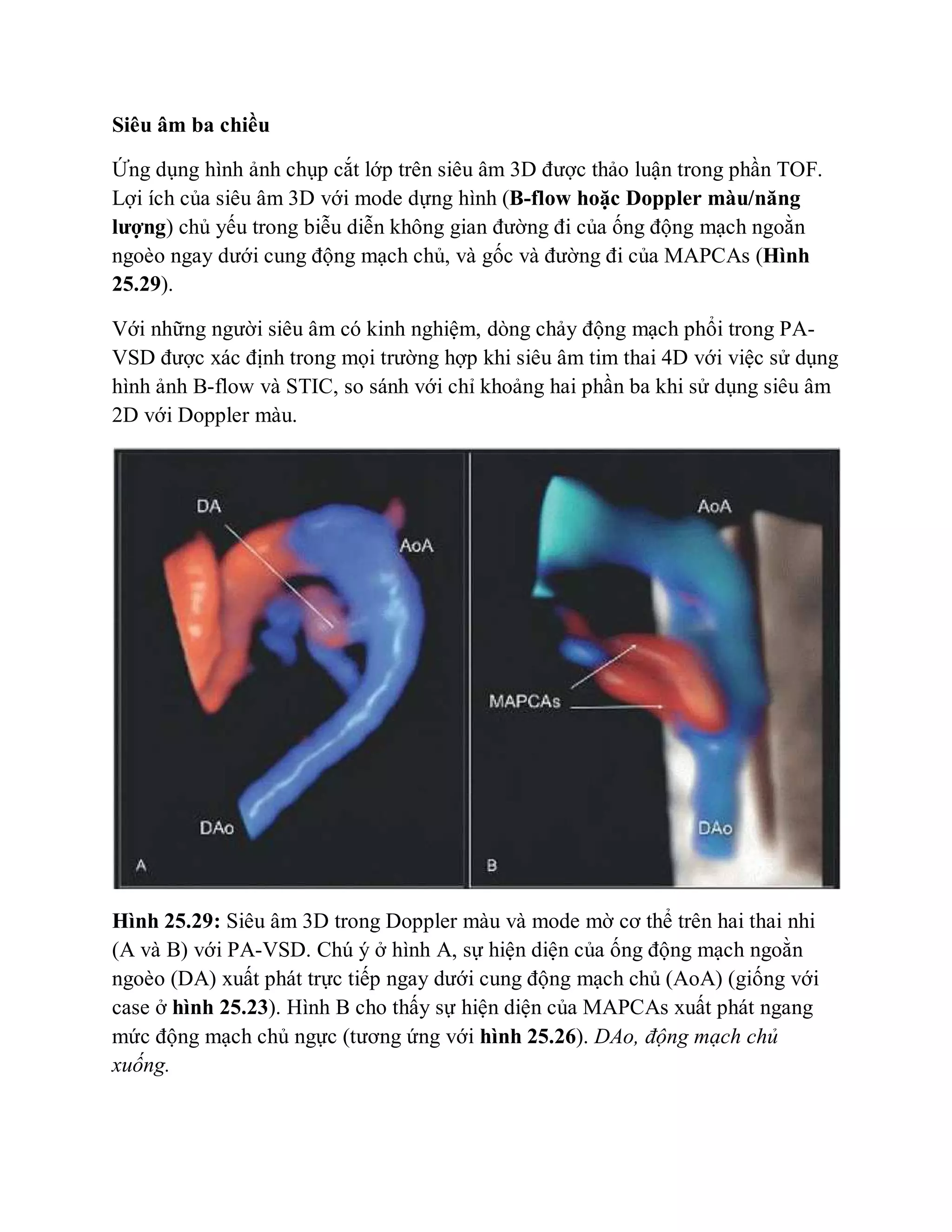 Pulmonary atresia with ventricular septal defect | PDF