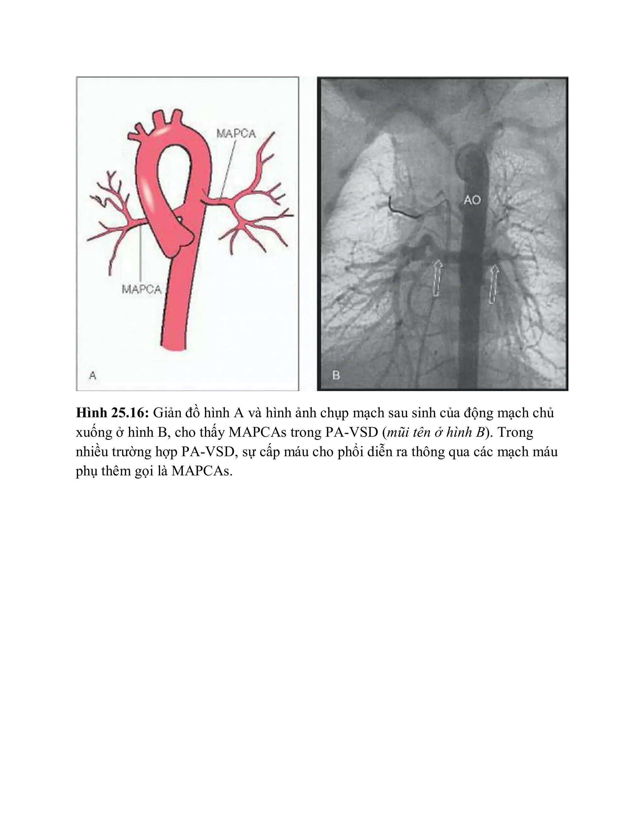 Pulmonary atresia with ventricular septal defect | PDF
