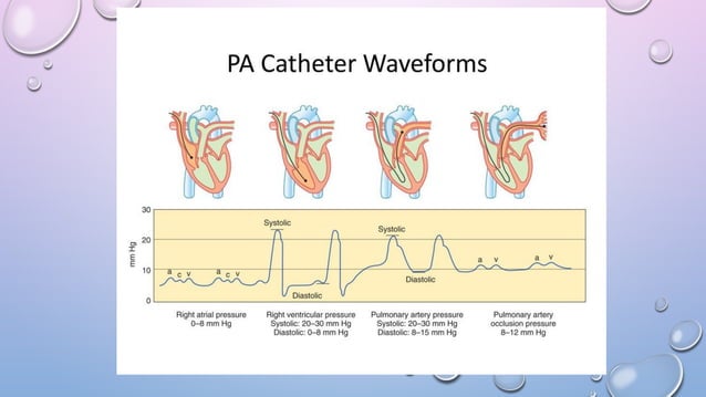 Pulmonary capillary wedge pressure or PCWP.pptx